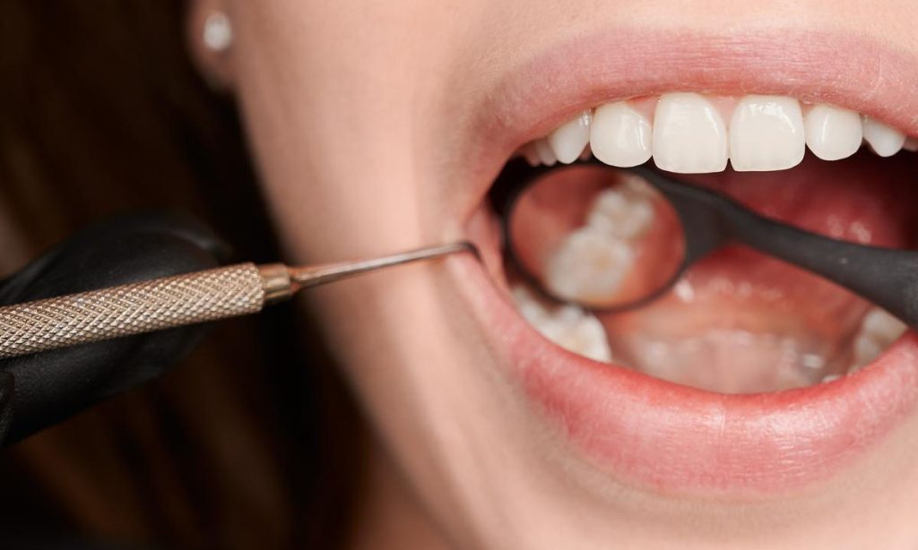 Root Canal Infection | 5 Ways to Prevent and Optimize