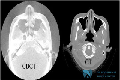 Difference between CBCT and CT | 5 Practical Advantages